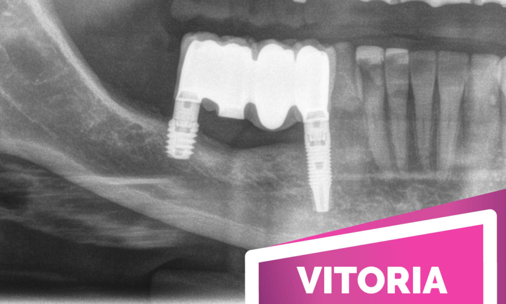 BTI Implant System – Iniciación [octubre 2026] – BTI Training Center