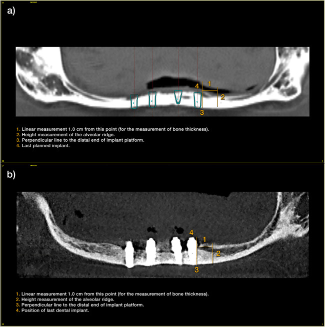 Implant-supported prosthesis under progressive loading protocol ...