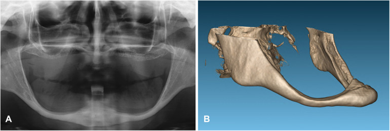 Implant-supported prosthesis under progressive loading protocol ...