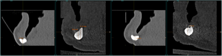 Implant-supported prosthesis under progressive loading protocol ...