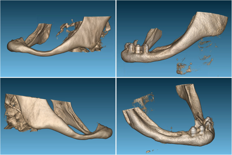 Implant-supported prosthesis under progressive loading protocol ...