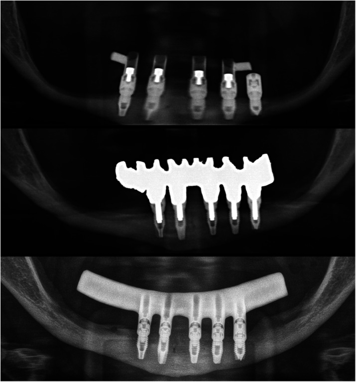 Implant-supported prosthesis under progressive loading protocol ...