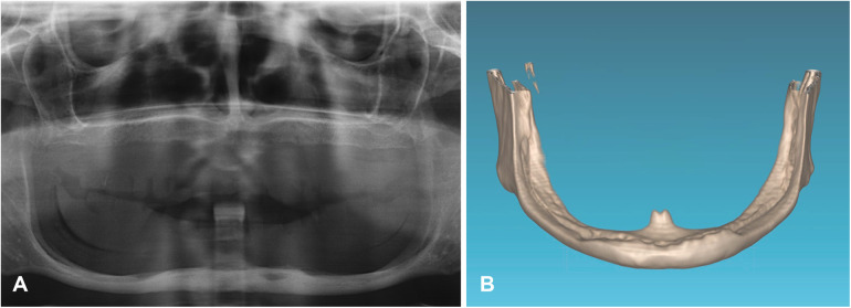 Implant-supported prosthesis under progressive loading protocol ...