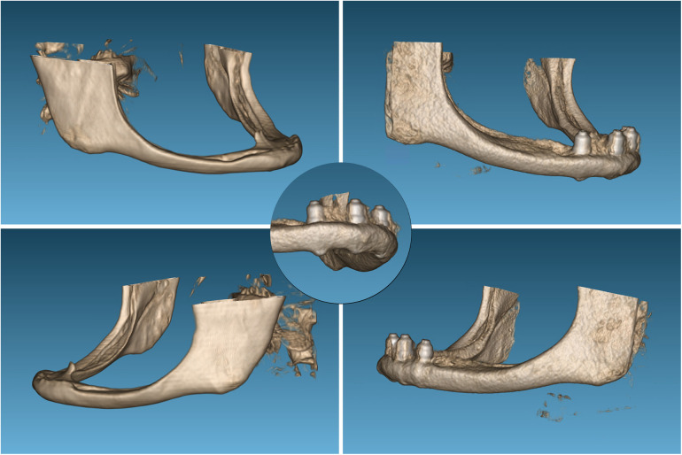 Implant-supported prosthesis under progressive loading protocol ...