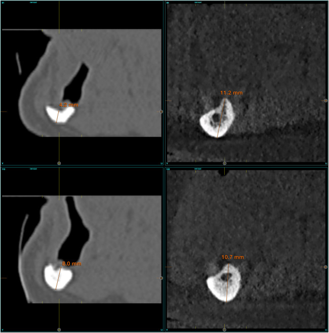 Implant-supported prosthesis under progressive loading protocol ...