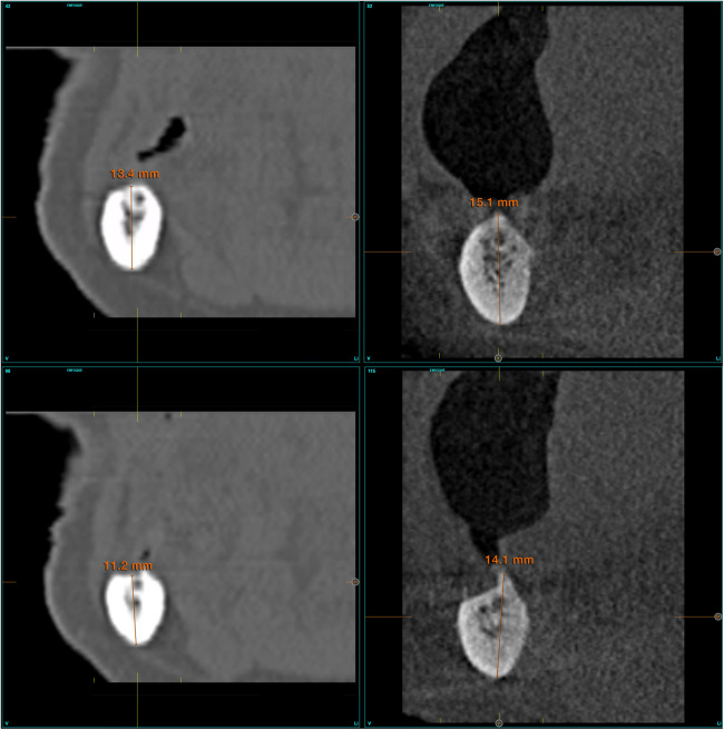 Implant-supported prosthesis under progressive loading protocol ...